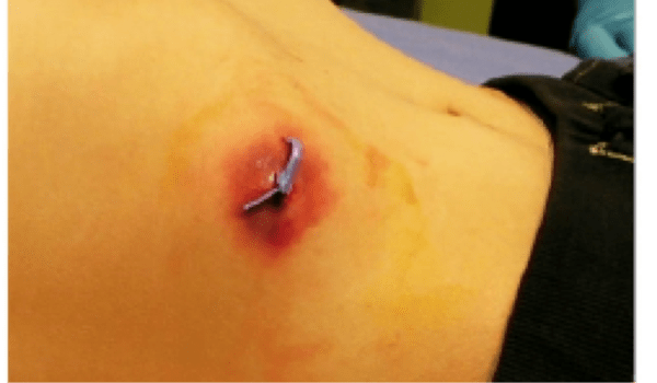 Simple Abscess Clinical Practice Guideline | PEMCONNECT