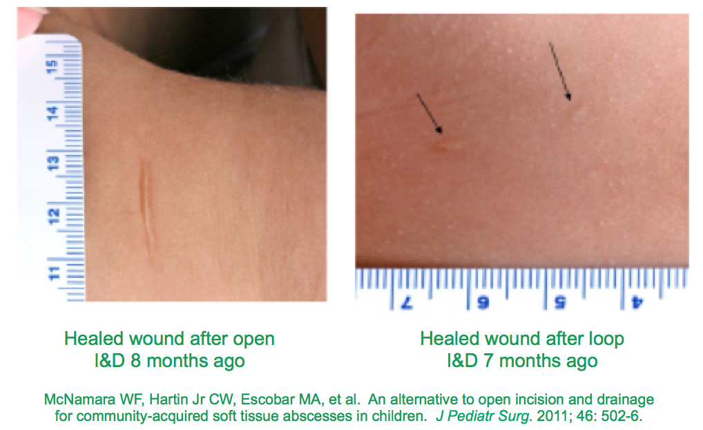 Simple Abscess Clinical Practice Guideline | PEMCONNECT