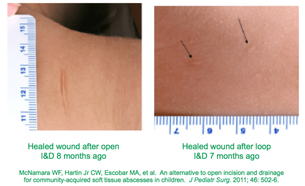 Simple Abscess Clinical Practice Guideline | PEMCONNECT